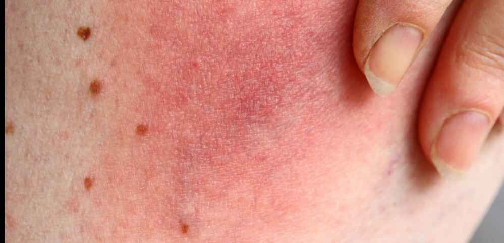 Enfermedad de Lyme: síntomas y cura | Hospitales Parque