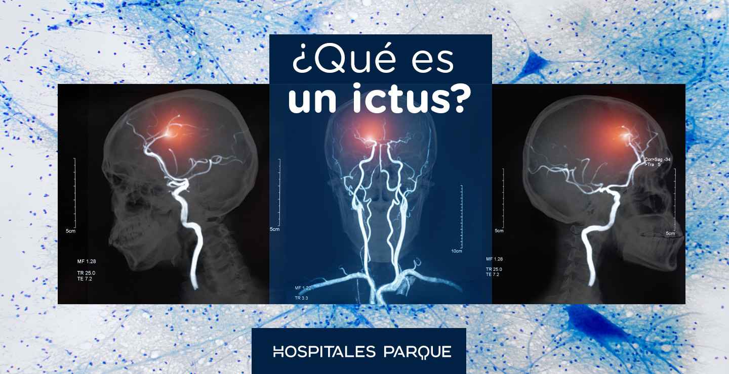 Qué es un ictus: síntomas y prevención | Hospitales Parque